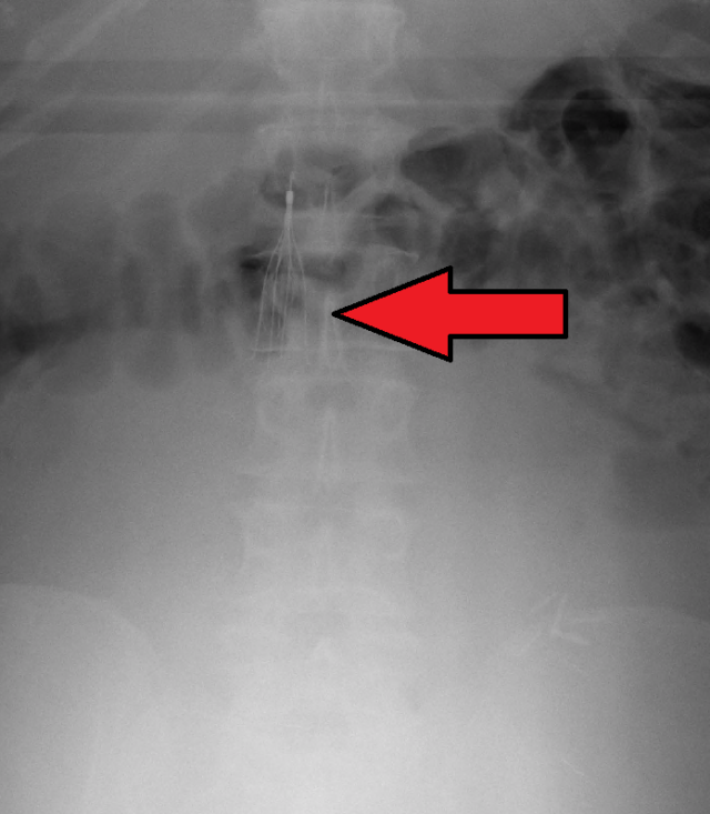IVC Filter Guidelines from Interventional Radiology IVC Filter Guidelines from Interventional Radiology