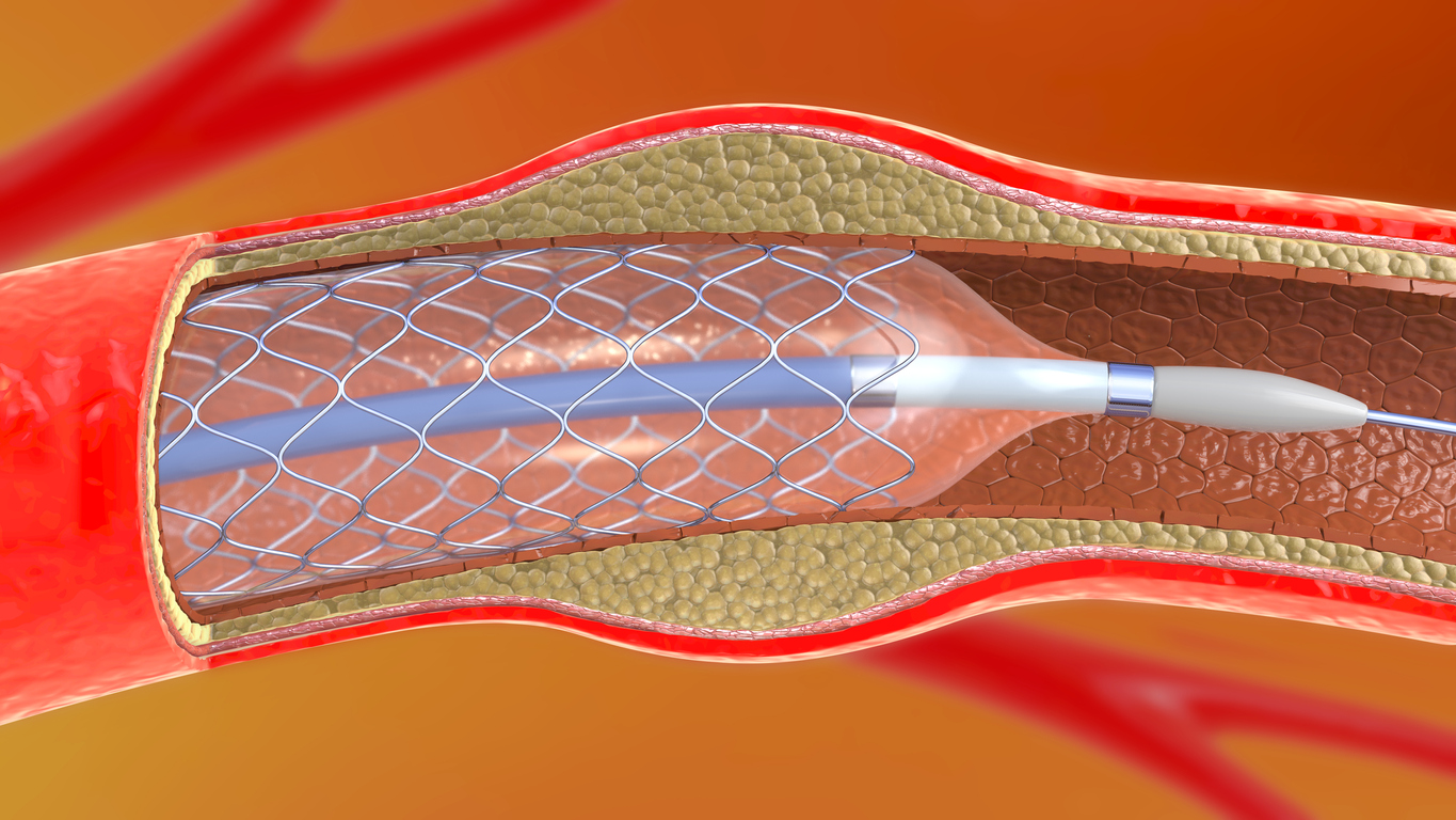 Catheters - Medical Community Urged To ‘Immediately Stop Using Affected ... Catheters - Medical Community Urged To ‘Immediately Stop Using Affected ...