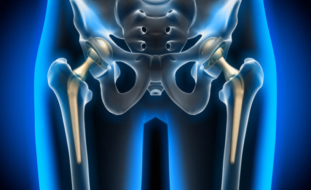 Hip Replacement Revision Surgery – What You Should Know
